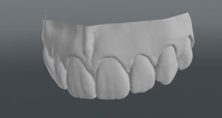 3D Files (STL and EXOCAD) - Anteriores Templates