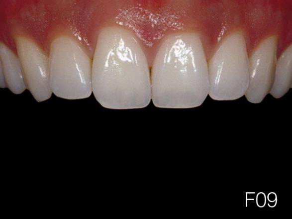 product-F09-photo - Anteriores Templates