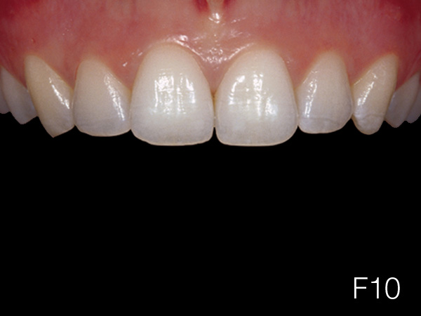 product-F10-photo - Anteriores Templates